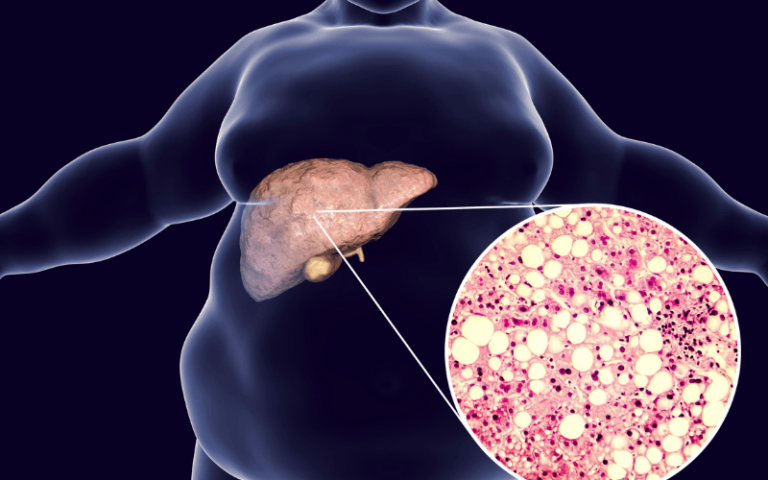 Fatty Liver Disease: Symptoms, Causes, and Prevention