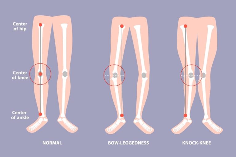 What is Rickets: Symptoms, Causes, and How to Manage it