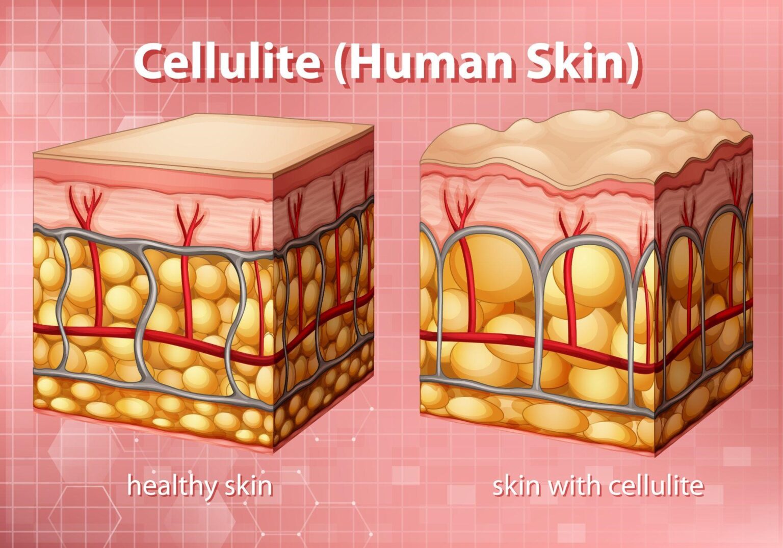 Cellulitis Treatment: Antibiotic Cream, Cellulitis Treatment at Home