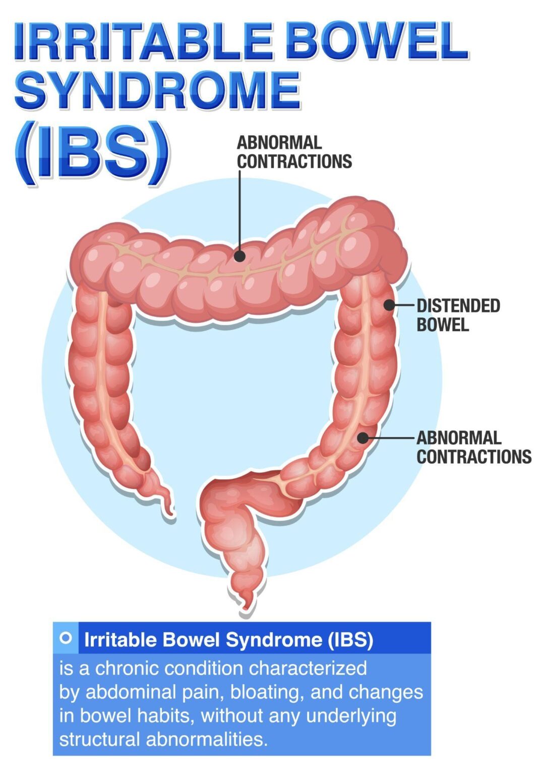 Treatment for Irritable Bowel Syndrome: IBS Treatment