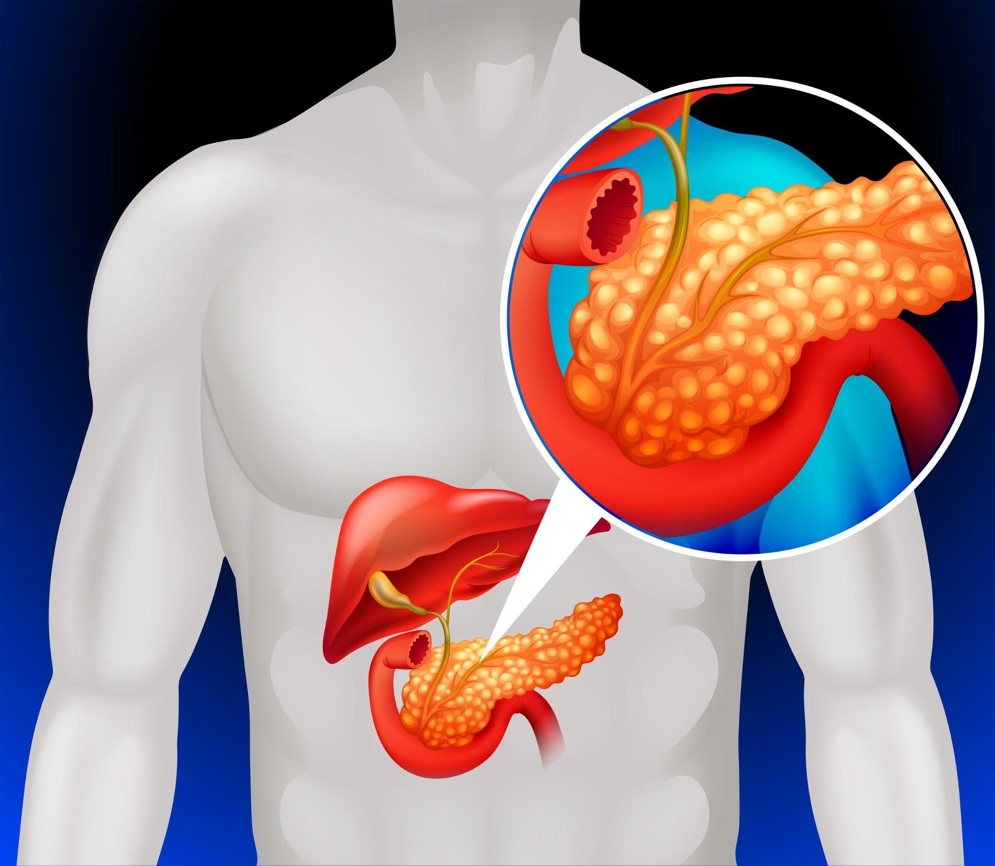 Treatment for Pancreatitis: Ayurvedic, Home Chronic Pancreatitis Treatment