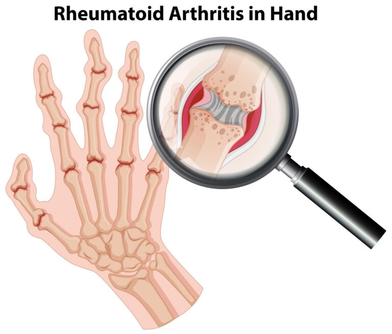 Rheumatoid Arthritis Diagnosis and Treatment: Drugs, Side Effects