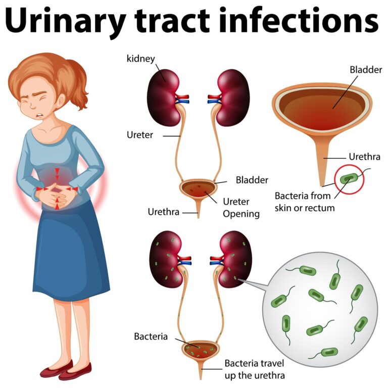Best Treatment for Urinary Tract Infection: UTI Treatment