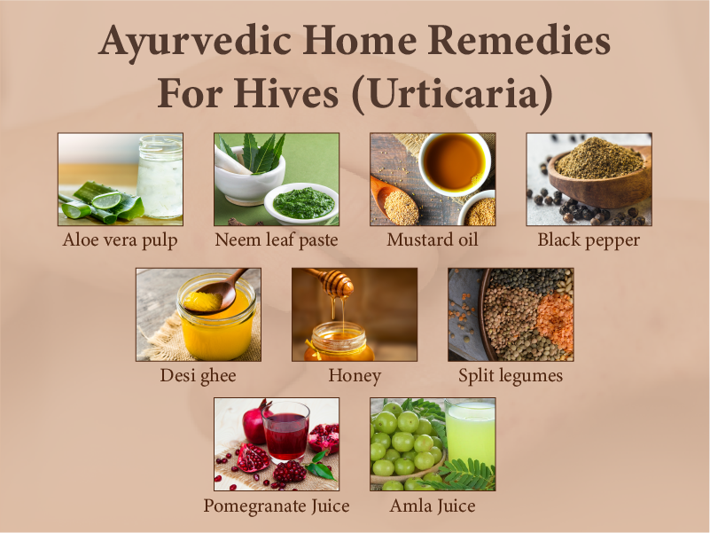 Urticaria Treatment At Home Urticaria Treatment At Home