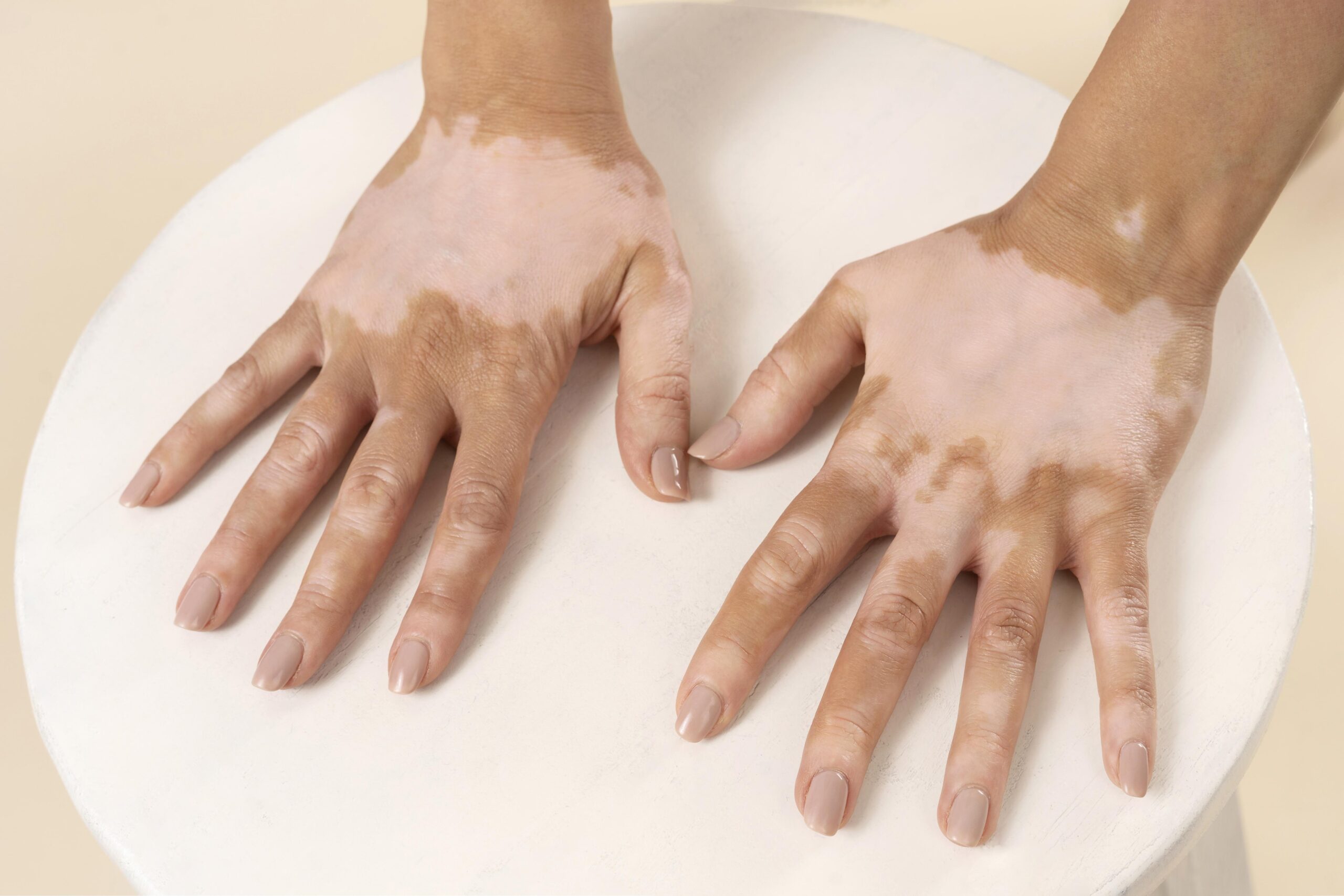 Vitiligo Treatment: Natural Remedies, Home Vitiligo Treatment