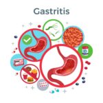 Gastritis Treatment - Best Treatment for Gastritis