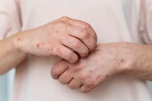 Common Skin Infections: Causes, Symptoms, and Treatment - Medkart ...