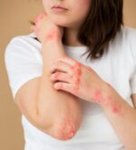 Common Skin Infections: Causes, Symptoms, and Treatment - Medkart ...