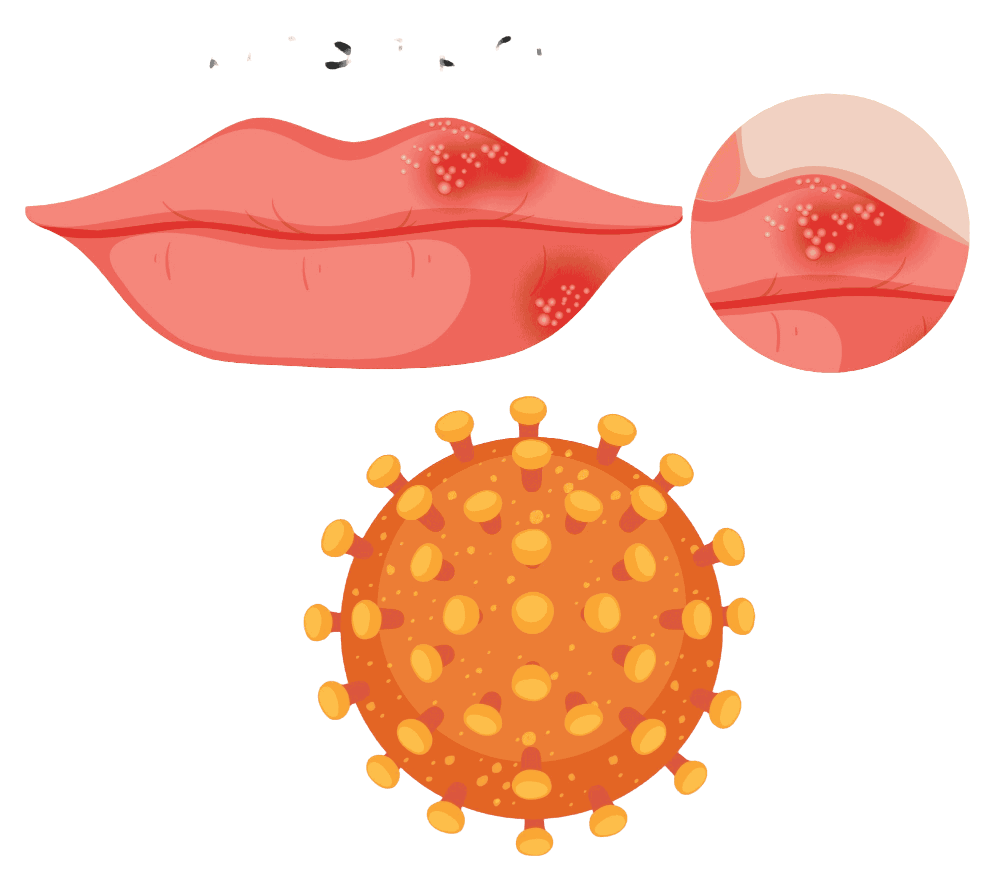 Viral Infections : Herpes Simplex, Warts, and Shingles - Medkart ...